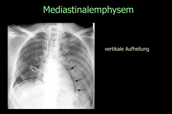 PPT - Thoraxtrauma PowerPoint Presentation - ID:6947283