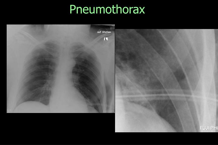 PPT - Thoraxtrauma PowerPoint Presentation - ID:6947283