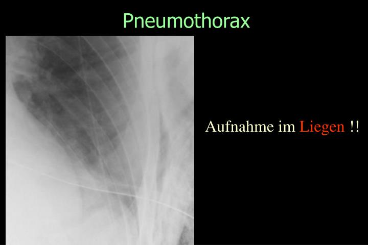 PPT - Thoraxtrauma PowerPoint Presentation - ID:6947283
