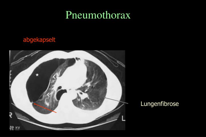 PPT - Thoraxtrauma PowerPoint Presentation - ID:6947283