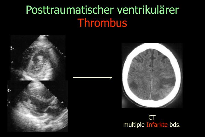 PPT - Thoraxtrauma PowerPoint Presentation - ID:6947283