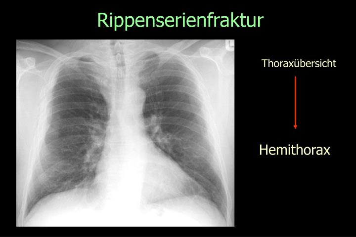 PPT - Thoraxtrauma PowerPoint Presentation - ID:6947283