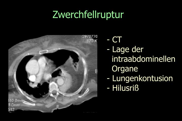 PPT - Thoraxtrauma PowerPoint Presentation - ID:6947283