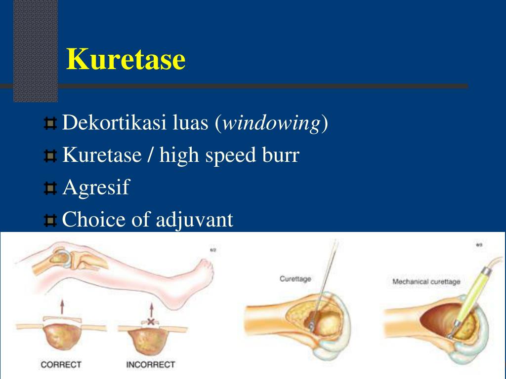 PPT - Giant Cell Tumor of Bone ( Osteoclastoma ) PowerPoint ...