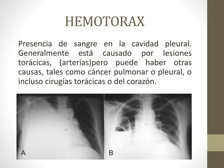 PPT - RADIOGRAFIA DE TORAX PowerPoint Presentation - ID:6949412