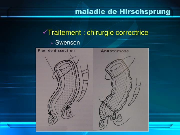 PPT - CHIRURGIE PEDIATRIQUE PowerPoint Presentation - ID:6957131