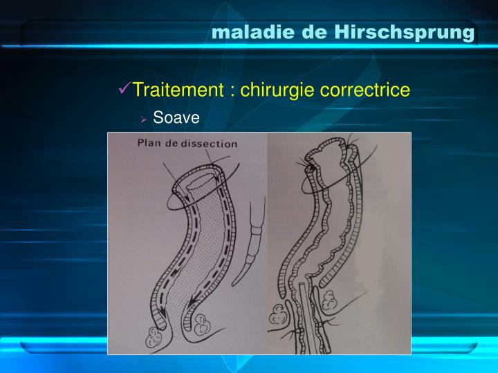 PPT - CHIRURGIE PEDIATRIQUE PowerPoint Presentation - ID:6957131