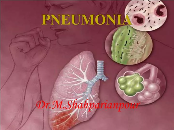 PPT - PNEUMONIA PowerPoint Presentation, free download - ID:6958808