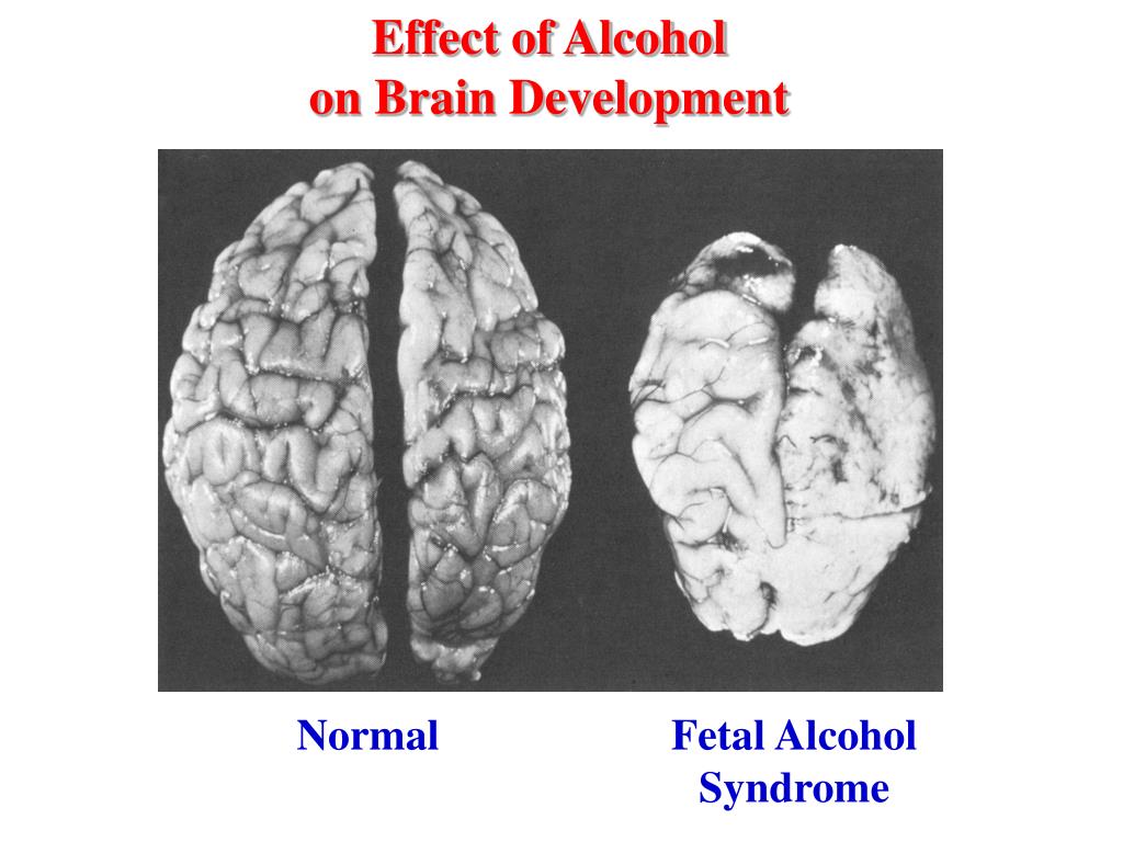 Ppt Effect Of Alcohol On Brain Development Powerpoint Presentation