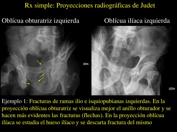 PPT - Evaluación con radiografía simple PowerPoint Presentation - ID ...