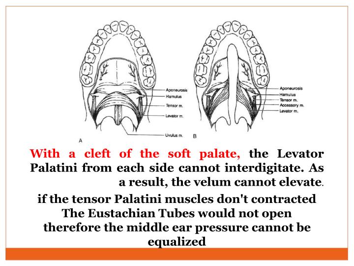 PPT - Morbid anatomy and pathophysiology in the cleft palate PowerPoint ...