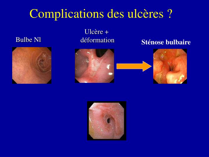 PPT - LES ULCERES GASTRO-DUODENAUX PowerPoint Presentation - ID:7004636