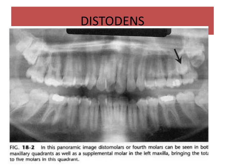 PPT - DENTAL ANOMALY PowerPoint Presentation - ID:7007534
