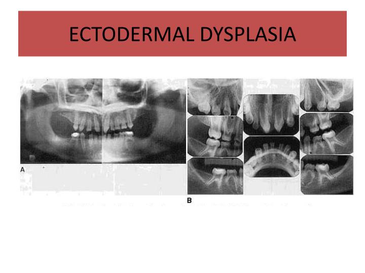 PPT - DENTAL ANOMALY PowerPoint Presentation - ID:7007534