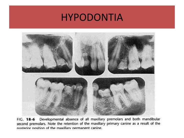 PPT - DENTAL ANOMALY PowerPoint Presentation - ID:7007534