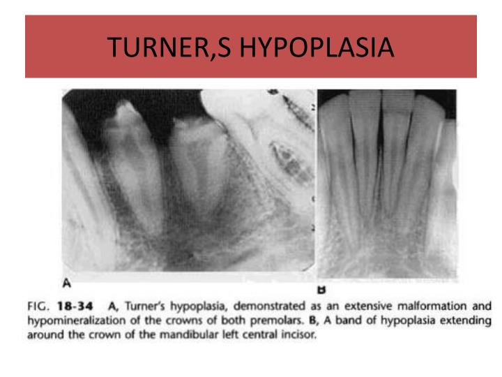 PPT - DENTAL ANOMALY PowerPoint Presentation - ID:7007534