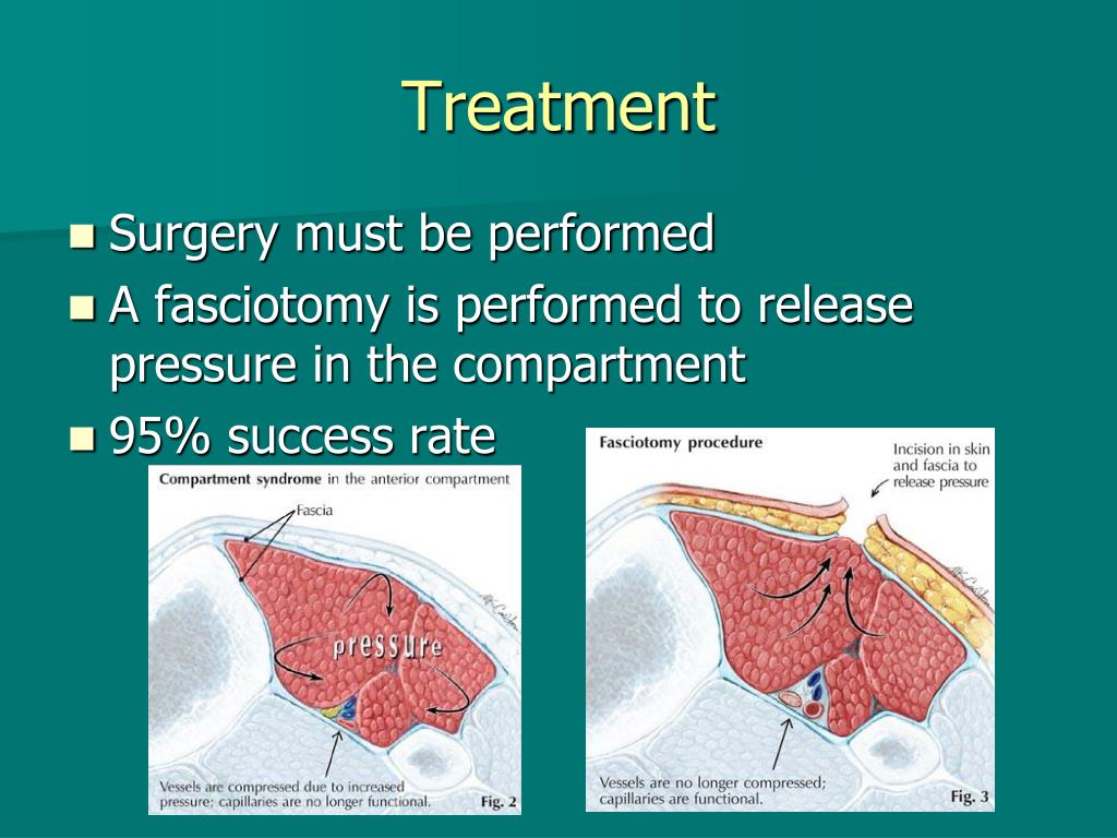PPT - Anterior Compartment Syndrome PowerPoint Presentation, free ...