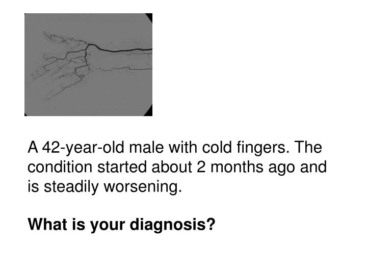 PPT - Hypothenar hammer syndrome PowerPoint Presentation - ID:7019760