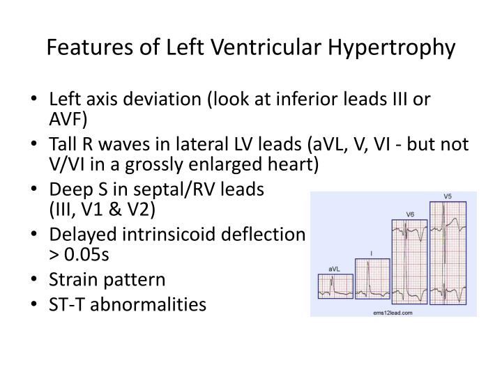 PPT - ECG of the Enlarged Heart PowerPoint Presentation - ID:7031786
