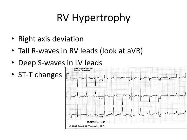 PPT - ECG of the Enlarged Heart PowerPoint Presentation - ID:7031786