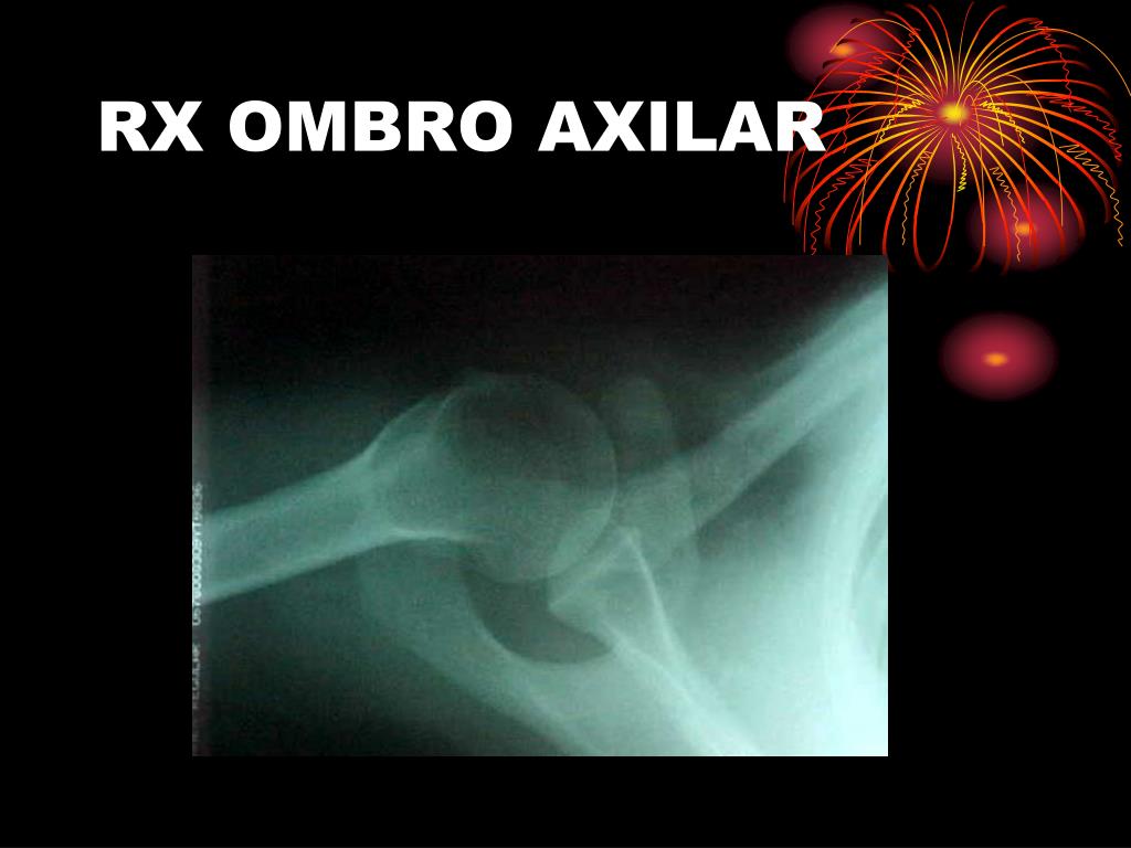 PPT - Radiologia ombro PowerPoint Presentation, free download - ID:7033509