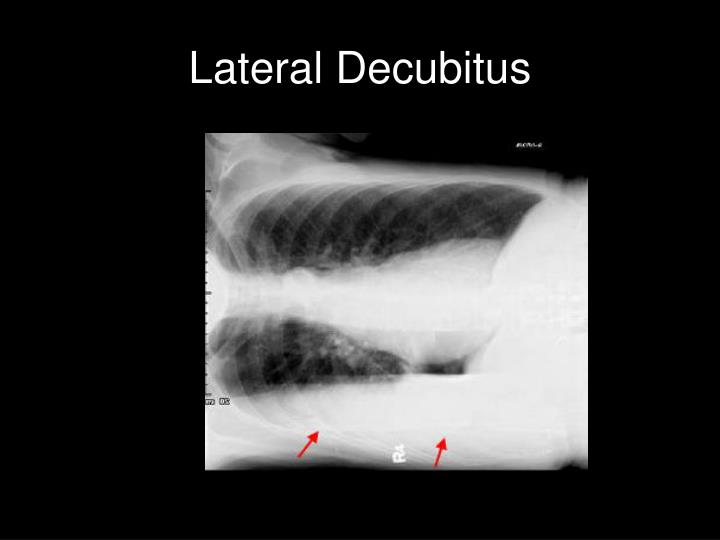 PPT - Chest X-ray PowerPoint Presentation - ID:7036416