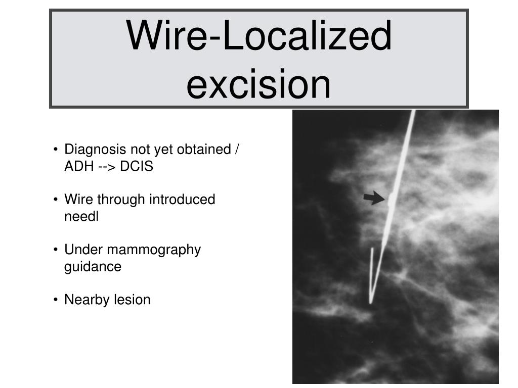 PPT - Benign Disease of the Breast PowerPoint Presentation, free ...