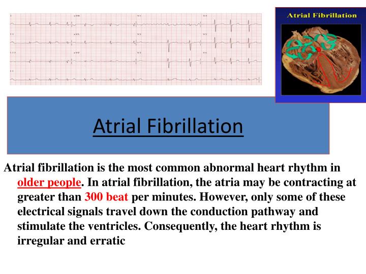 PPT - Arrhythmia PowerPoint Presentation - ID:7039680
