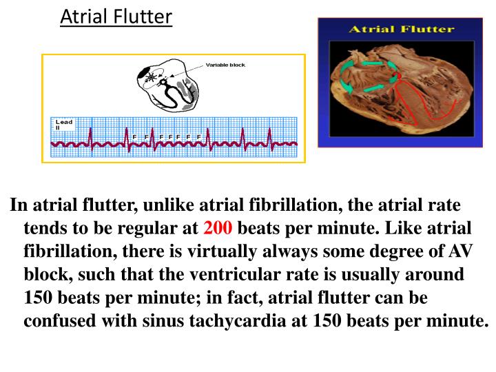 PPT - Arrhythmia PowerPoint Presentation - ID:7039680
