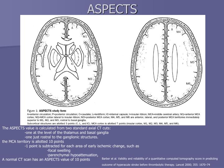 PPT - Thrombolytic Therapy for Acute Ischemic Stroke: Should it be used ...