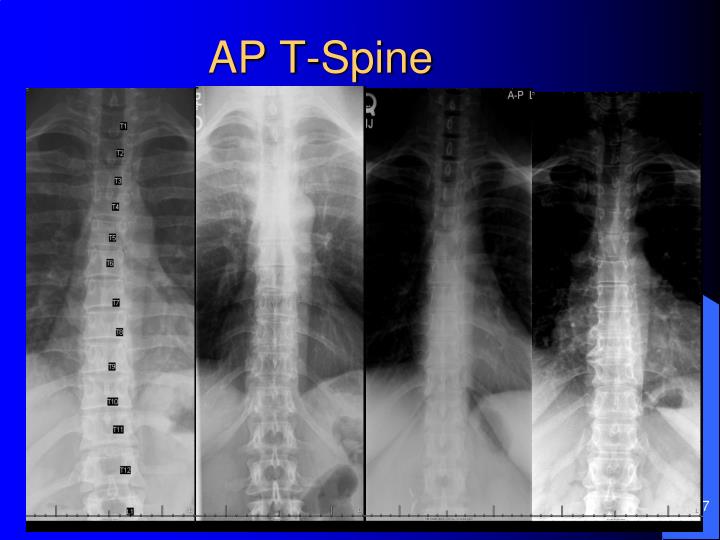 PPT - T Spine PowerPoint Presentation - ID:7046224
