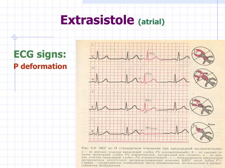 PPT - Disorders of heart rhythm PowerPoint Presentation - ID:7047988