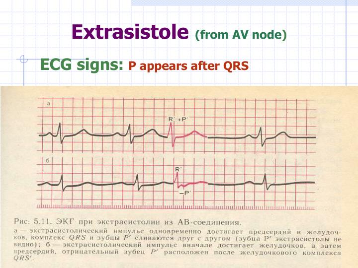 PPT - Disorders of heart rhythm PowerPoint Presentation - ID:7047988