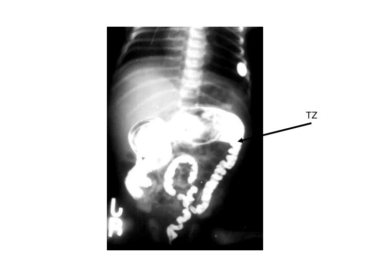 Ppt Hirschsprungs Disease Congenital Megacolon Powerpoint
