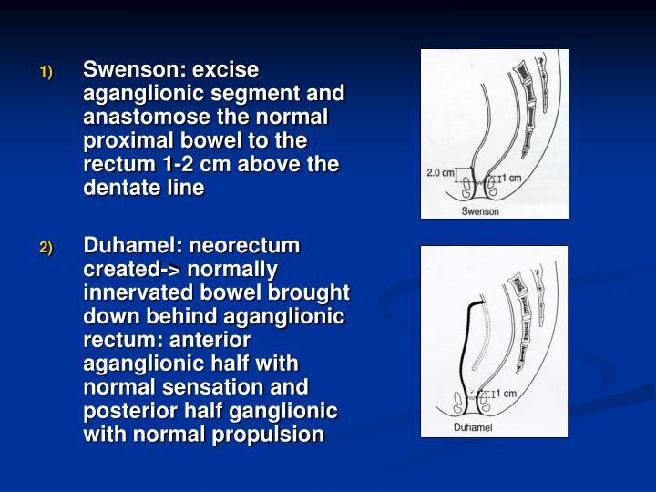 PPT - Congenital Megacolon (Hirschsprung’s disease) PowerPoint ...