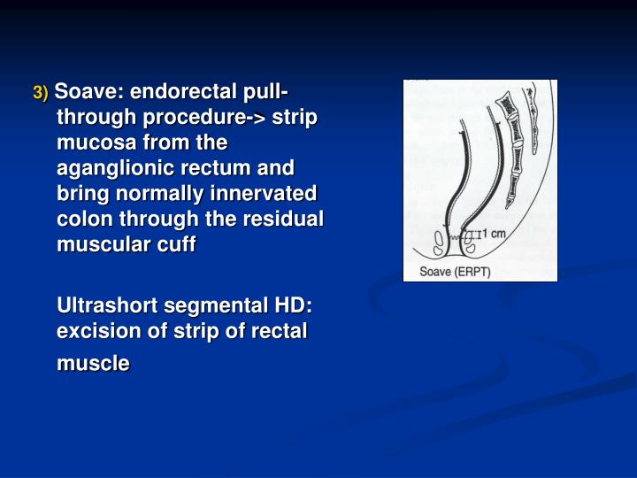 PPT - Congenital Megacolon (Hirschsprung’s disease) PowerPoint ...