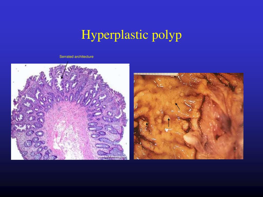PPT - Clinical Pathological Conference Colorectal Cancer PowerPoint ...
