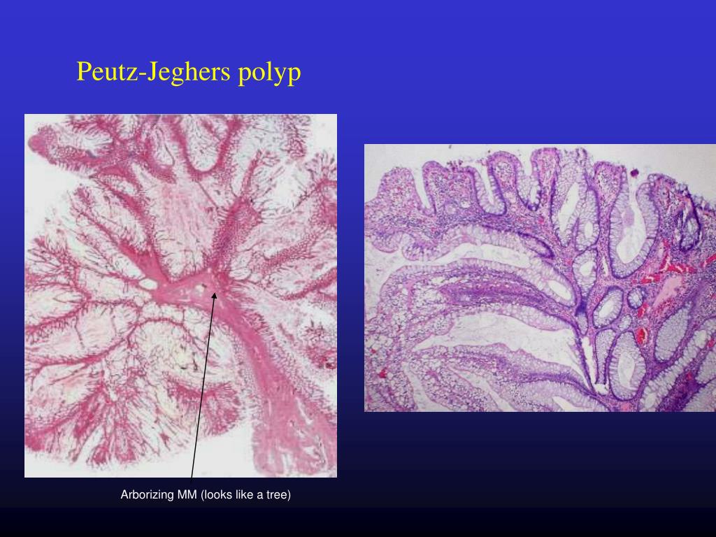 PPT - Clinical Pathological Conference Colorectal Cancer PowerPoint ...