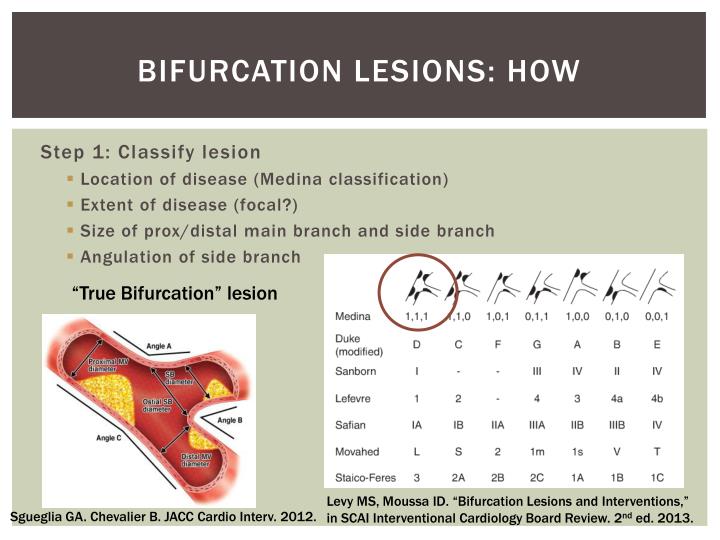 PPT - Bifurcation Stenting: A primer PowerPoint Presentation - ID:7078253