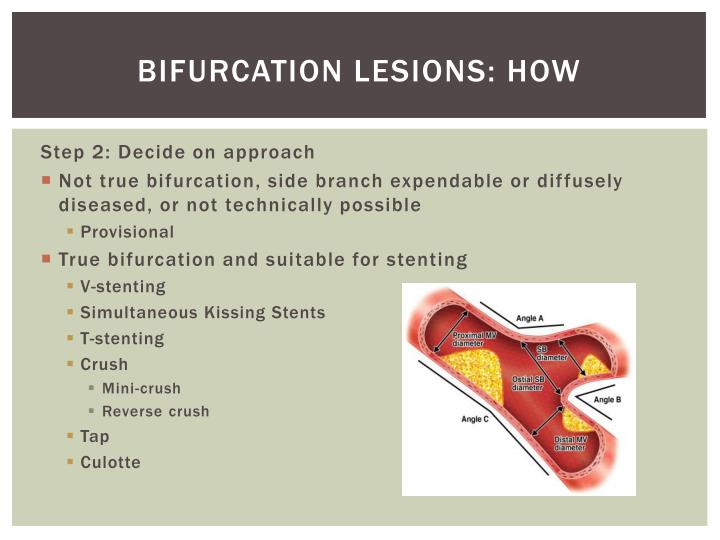 PPT - Bifurcation Stenting: A primer PowerPoint Presentation - ID:7078253