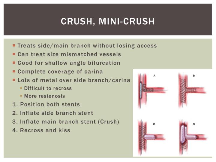 PPT - Bifurcation Stenting: A primer PowerPoint Presentation - ID:7078253
