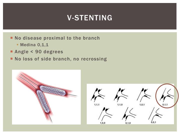 PPT - Bifurcation Stenting: A primer PowerPoint Presentation - ID:7078253