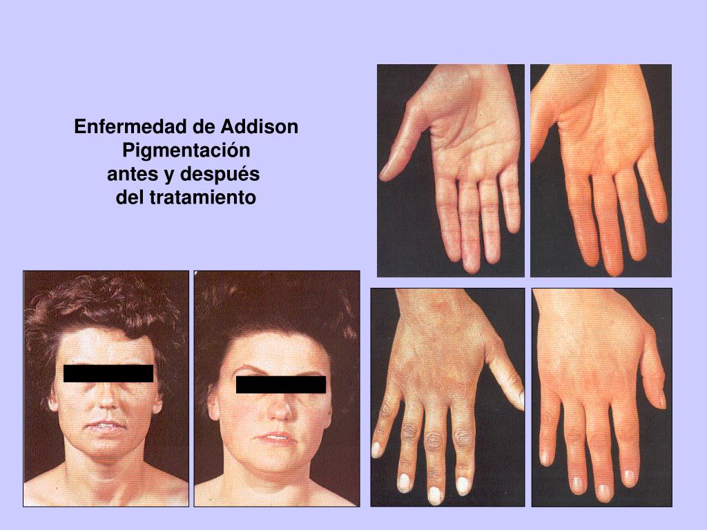 PPT - Enfermedad de Addison Síndrome pluriglandular autoinmune ...