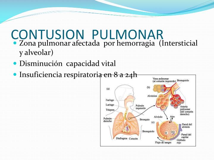 Contusion Pulmonar
