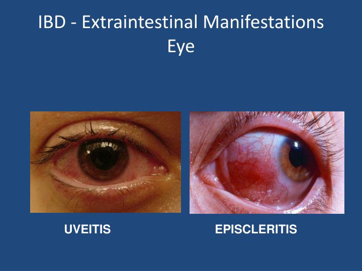 PPT - What’s So Special about Pediatric IBD ? PowerPoint Presentation ...