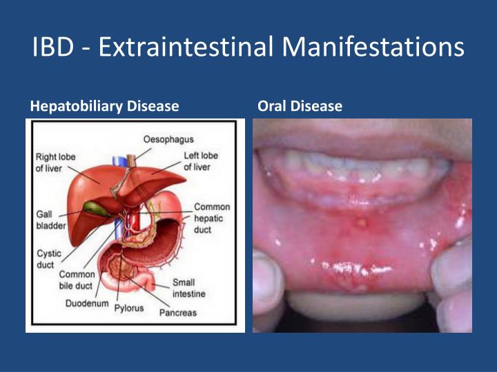 PPT - What’s So Special about Pediatric IBD ? PowerPoint Presentation ...