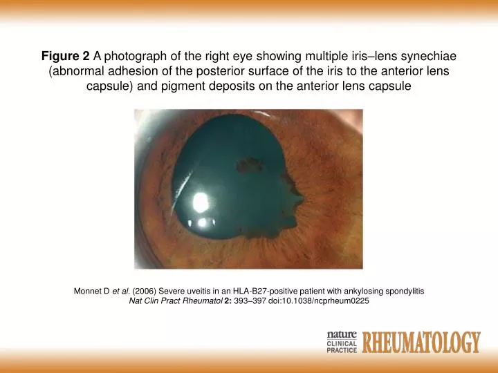 PPT - Monnet D et al. (2006) Severe uveitis in an HLA-B27-positive ...