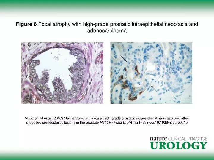 PPT - Figure 6 Focal atrophy with high-grade prostatic intraepithelial ...
