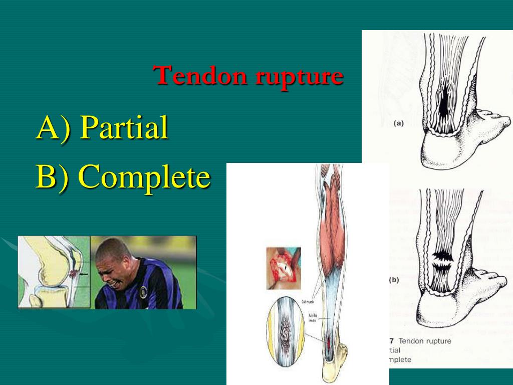 PPT - Sports Injuries Primary Care on-field دکتر باقری مقدم متخصص پزشکی ...