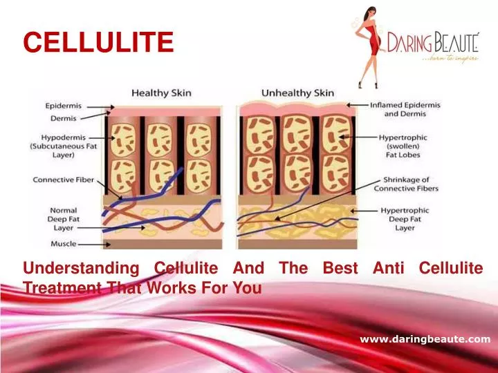 PPT - Understanding Cellulite And The Best Cellulite Treatment ...